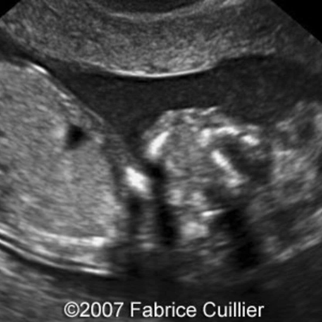 📃 Acrania and cardiac malformation
