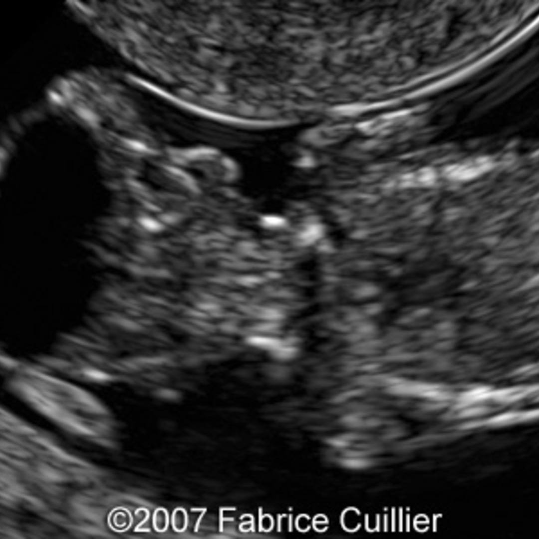 📃 Acrania and alobar holoprosencephaly
