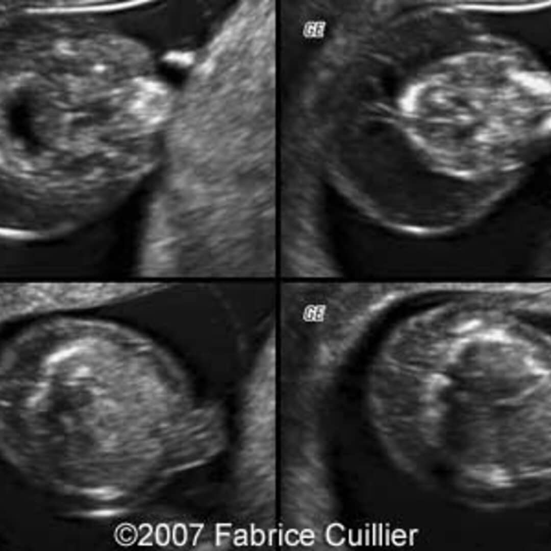 📃 Monosomy X, hygroma colli