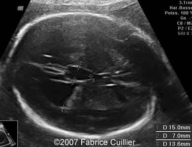 📃 Hydrocephalus, dysgenesis of the corpus callosum, atrioventricular ...