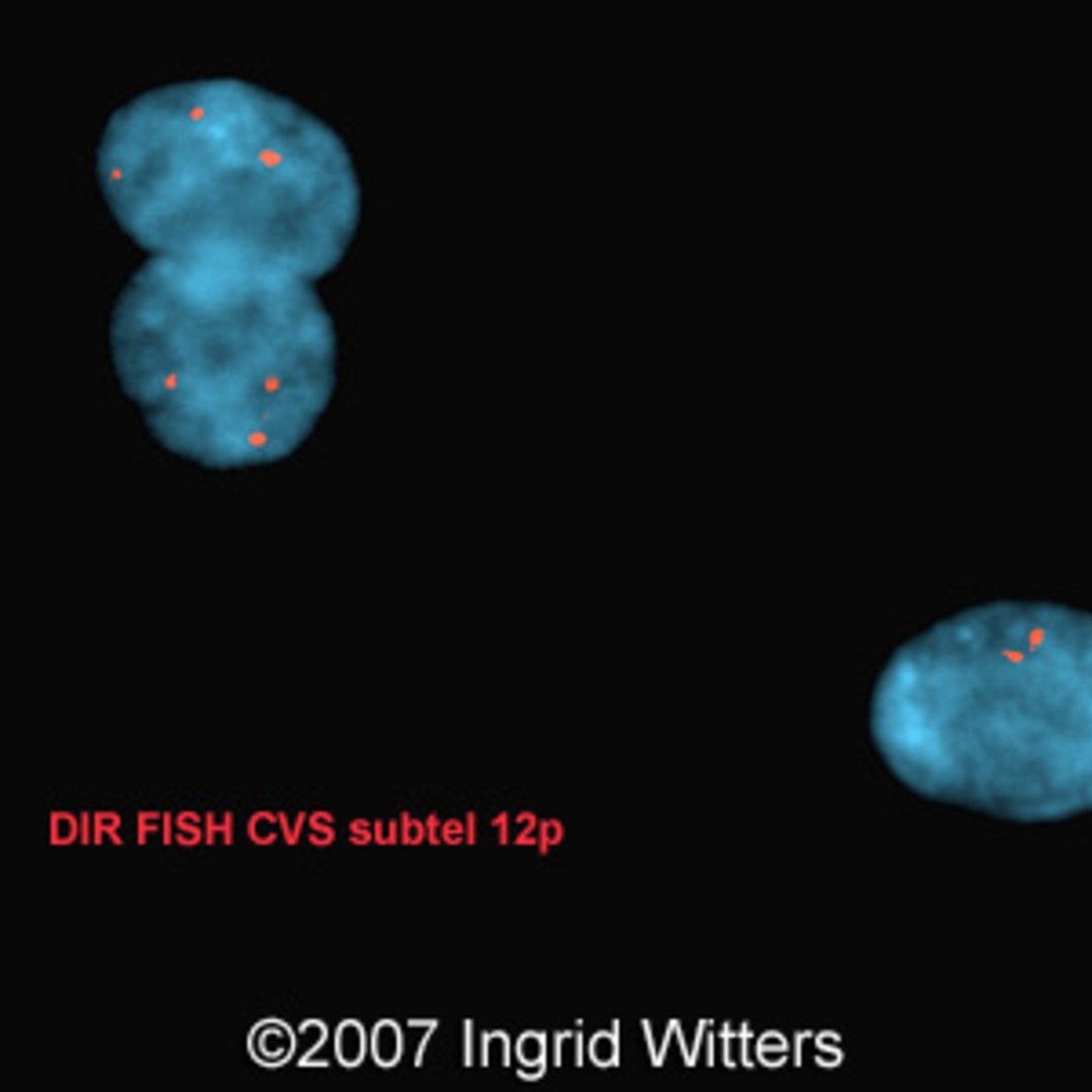 📃 Prenatal diagnosis by direct FISH on chorionic villi of duplication ...