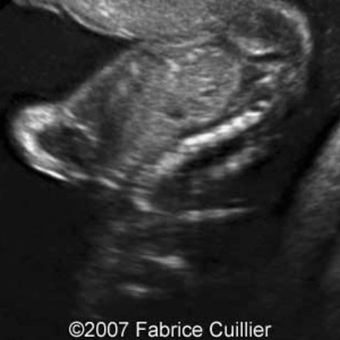 📃 Iniencephaly and acrania