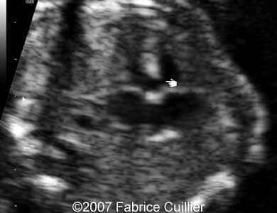 📃 VACTERL association