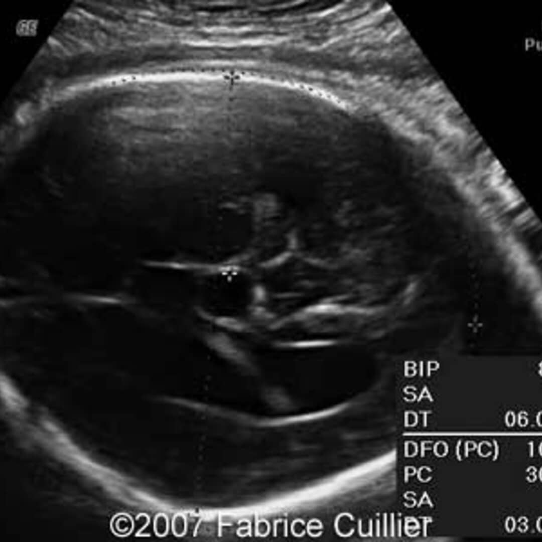 📃 Partial agenesis of the corpus callosum and cleft lip