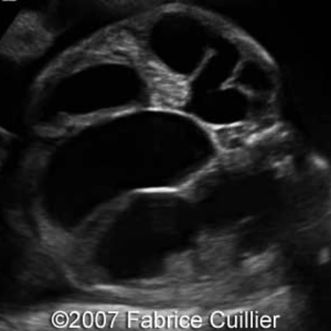 📃 Congenital megaurethra, 28 weeks