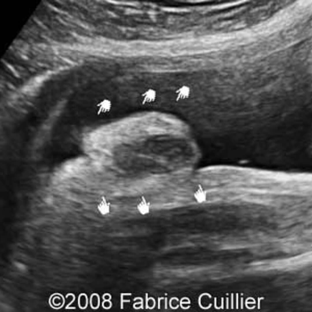 📃 Clitoral hypertrophy