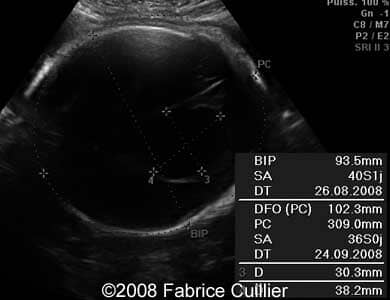 📃 Interhemispheric arachnoid cyst