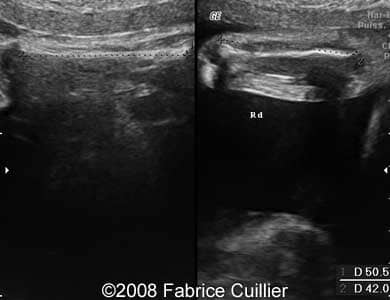 📃 Radial ray aplasia
