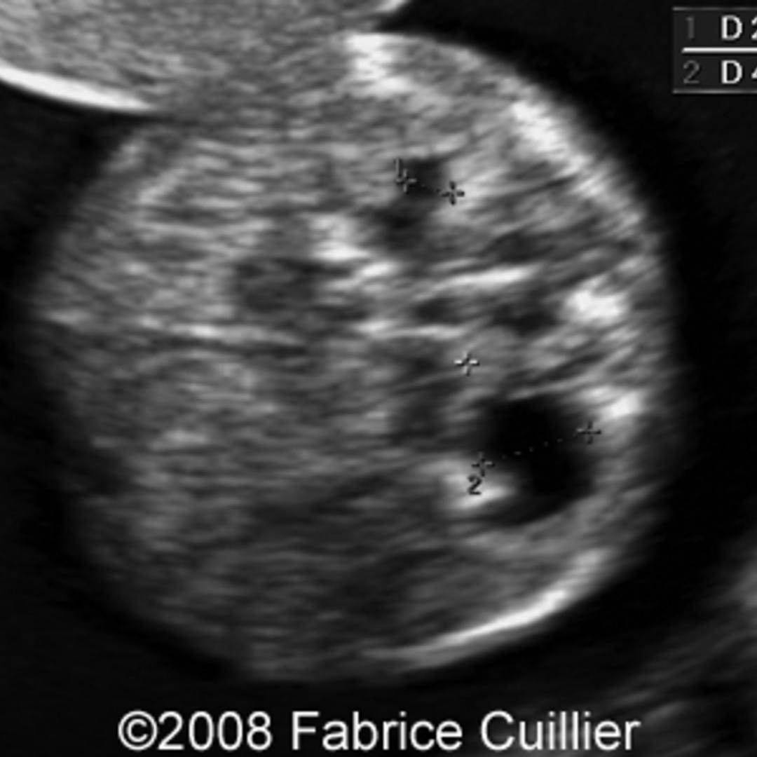 📃 Duplicated renal collecting system