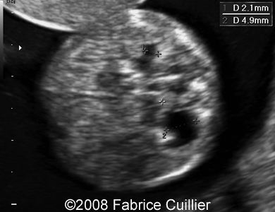 📃 Duplicated renal collecting system
