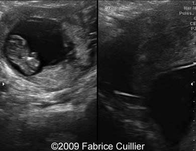 📃 Limb-body wall complex in ectopic pregnancy