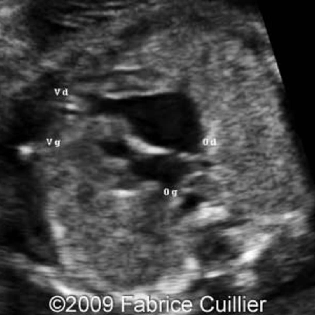 📃 Hypoplastic left heart syndrome