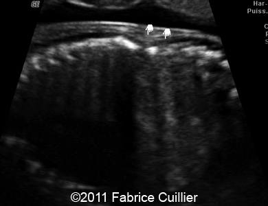 📃 VACTERL association