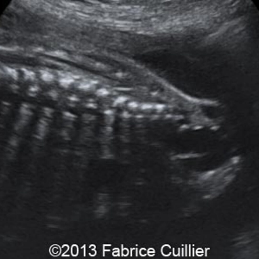 📃 Sacrococcygeal teratoma, 26 weeks