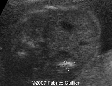 📃 Hepatic calcification