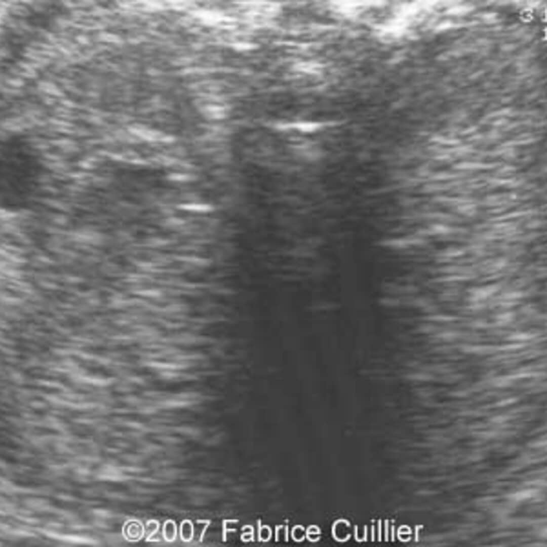 📃 Congenital splenic cyst: report of four cases