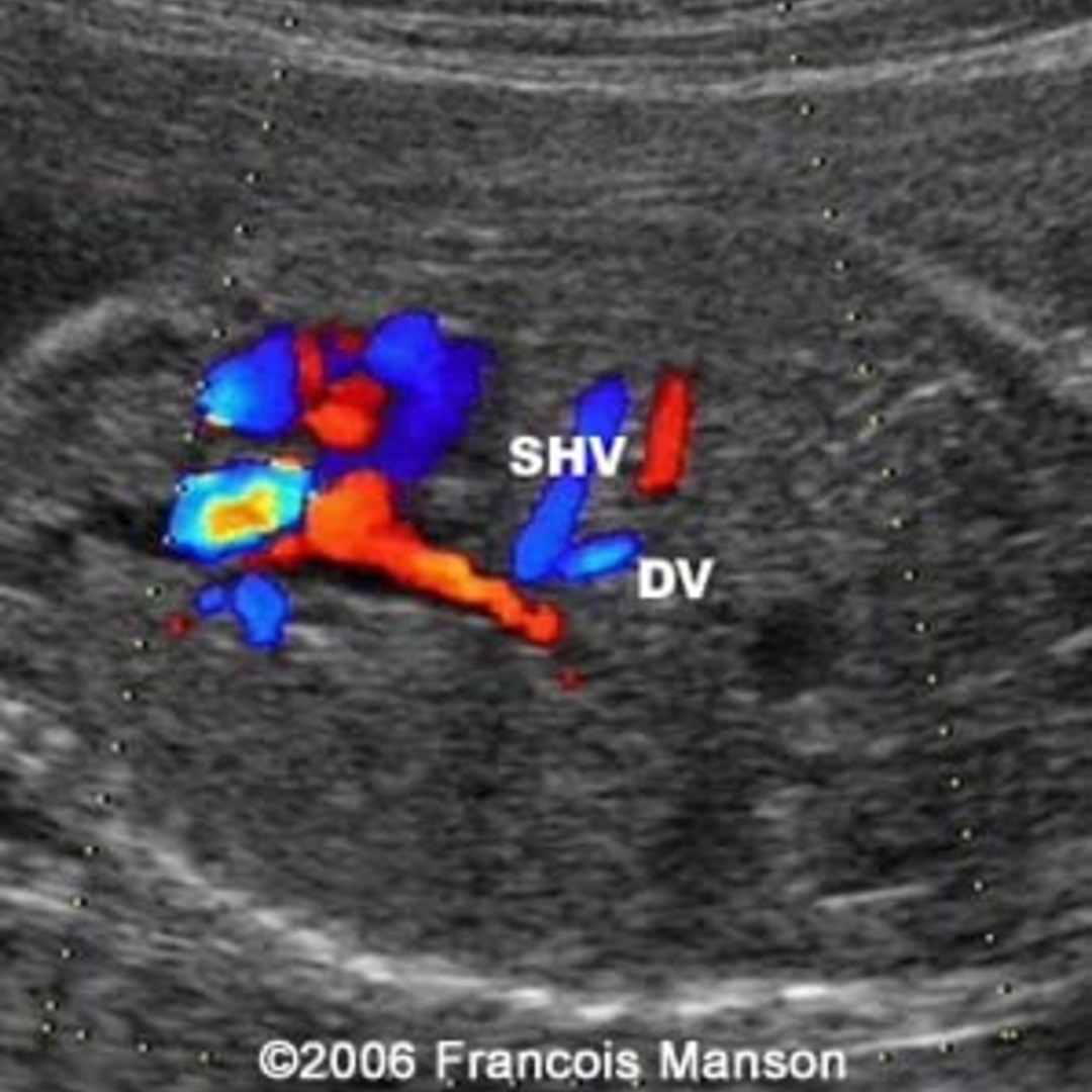 📃 Persistent right umbilical vein