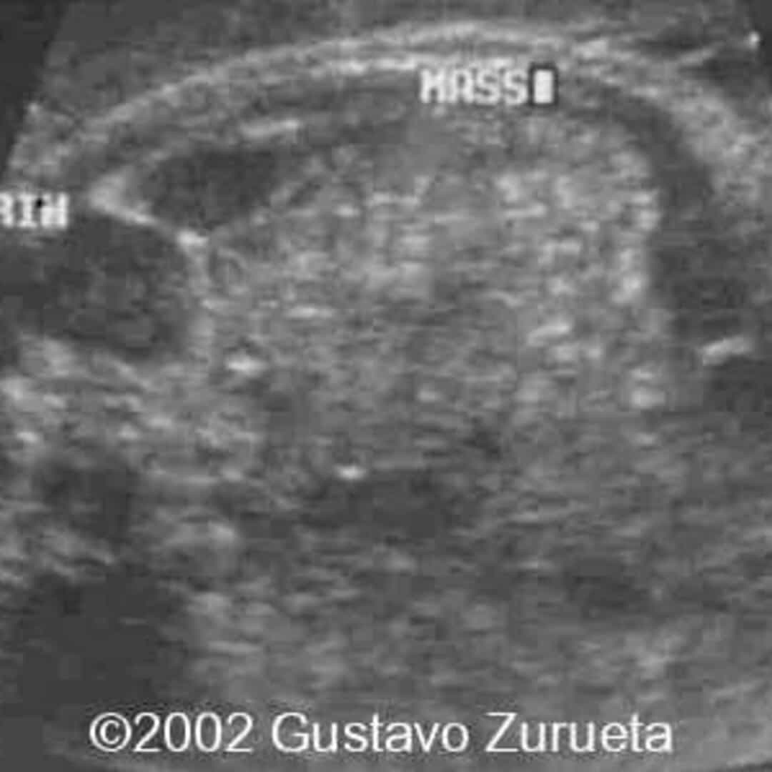 📃 Possible meconium plug