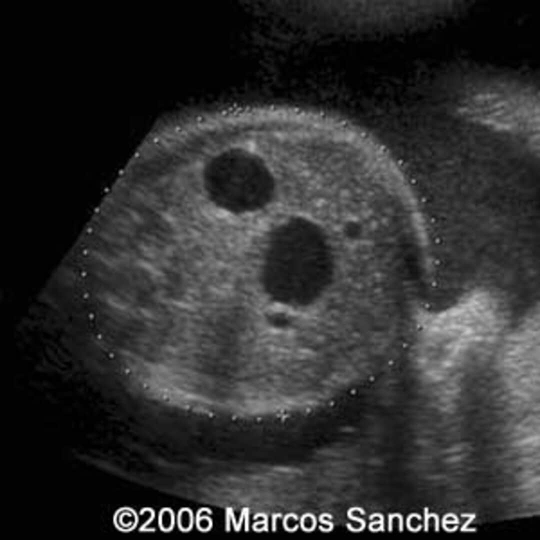 📃 Duodenal Atresia