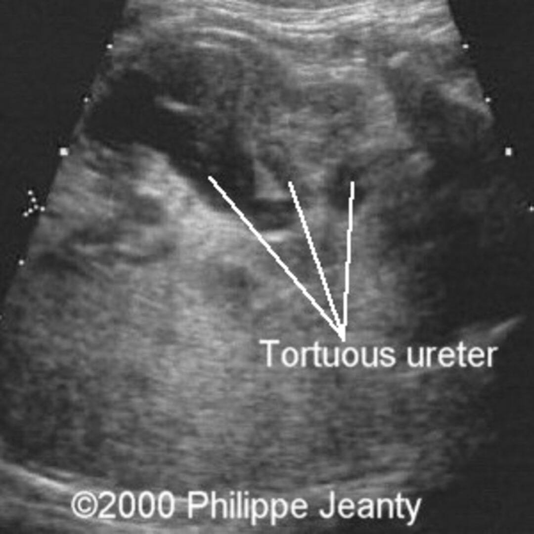 📃 Kidney duplication