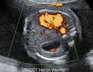 📃 Diaphragmatic hernia, left sided