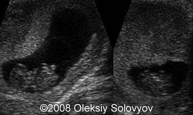 📃 Acrania, two cases