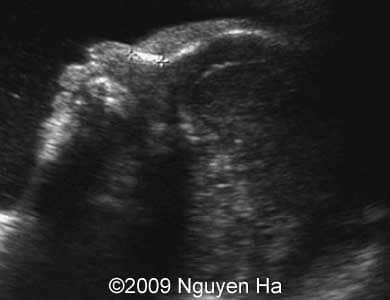 📃 Roberts syndrome