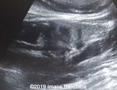 📃 Esophageal atresia