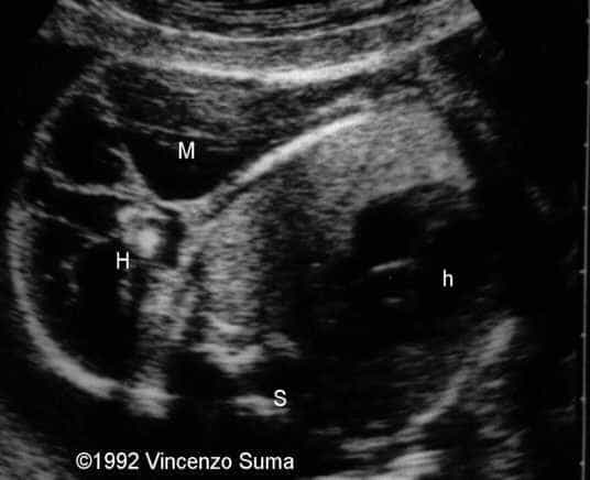 📃 Cystic hygroma, axillary, cervico-mediastinal