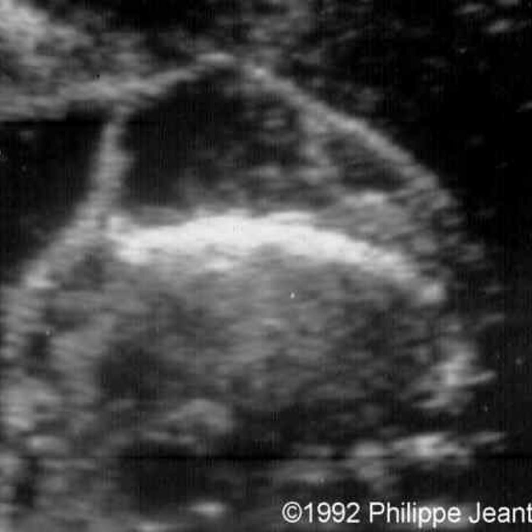 📃 Cystic hygroma, axillary