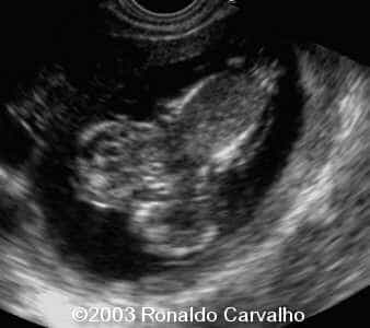 📃 Twins, conjoined