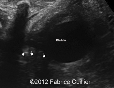 📃 Urinoma, different etiologies