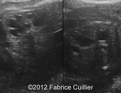📃 Ureterocele, obstructive
