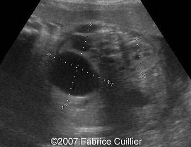 📃 Unilateral multicystic dysplastic kidney