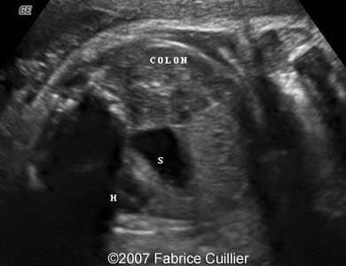 📃 Diaphragmatic hernia, absence of fibula and apodia, possible Cornelia ...