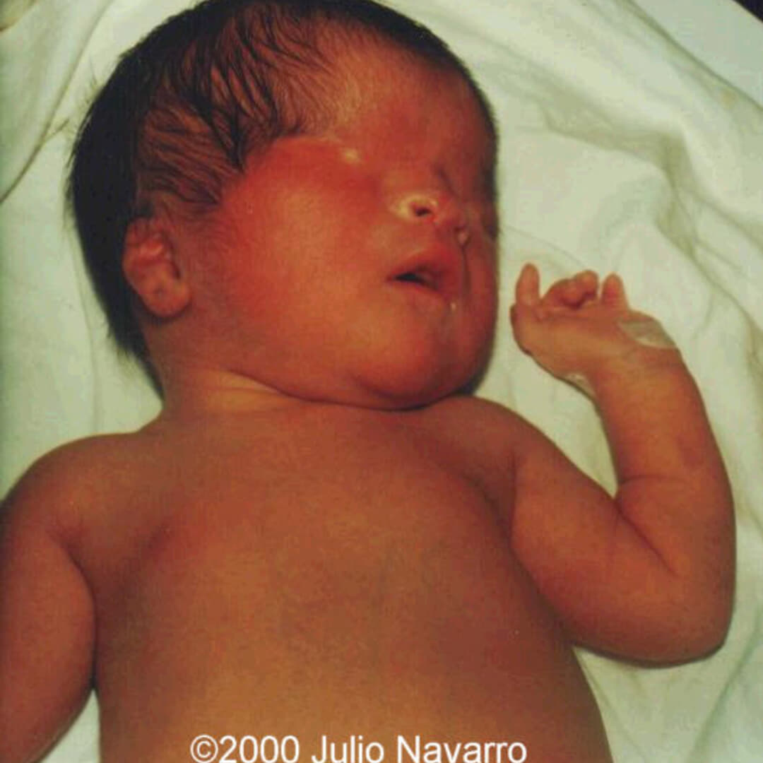 Nose Webbing Birth Defect