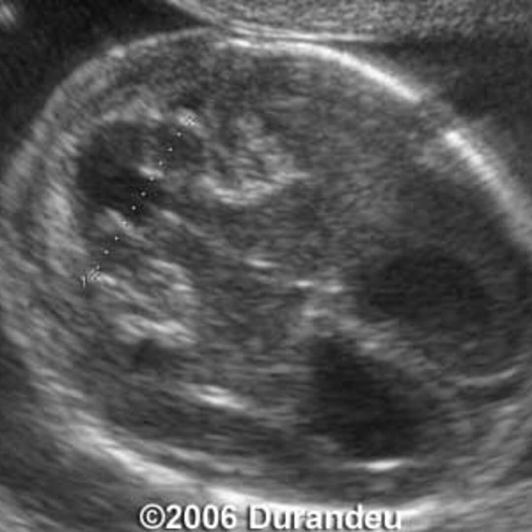 dandy walker malformation usg