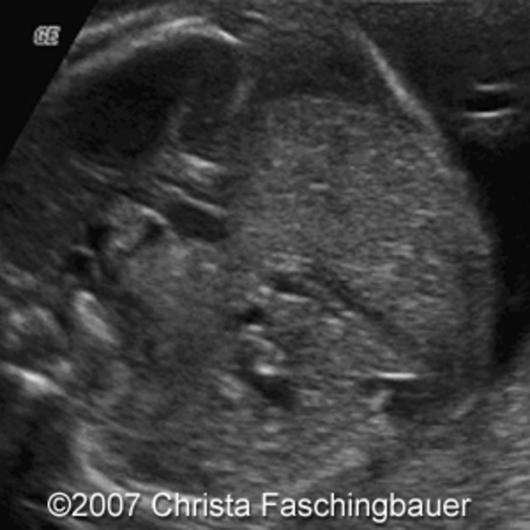 📃 Diaphragmatic hernia, right-sided