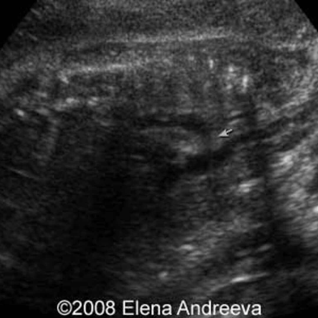 📃 Interrupted aortic arch, two cases