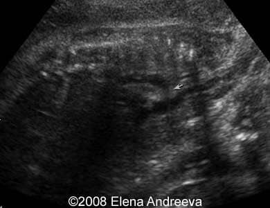 📃 Interrupted aortic arch, two cases