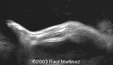 📃 Myotonic dystrophy