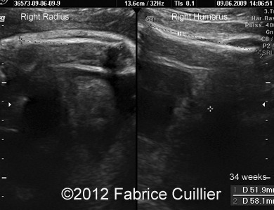 📃 Benign curved tibia