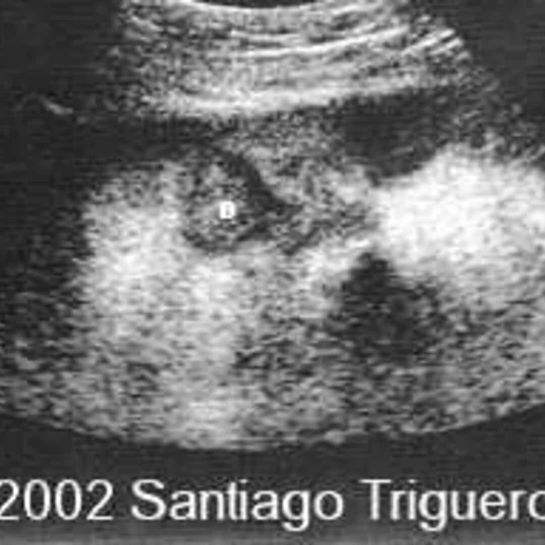 📃 Cystic hygroma, unilateral