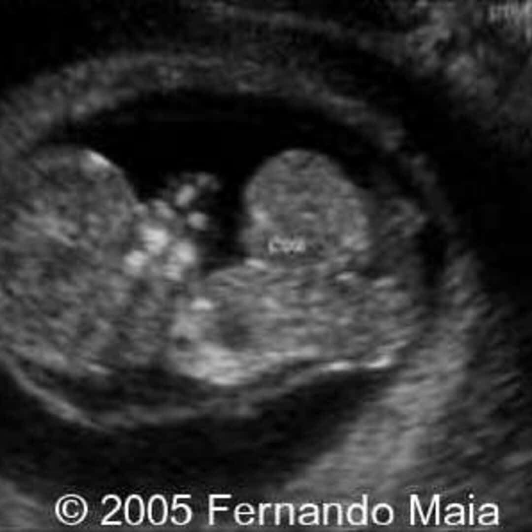 📃 Pentalogy of Cantrell, 10 weeks