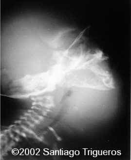 📃 Cystic hygroma, unilateral