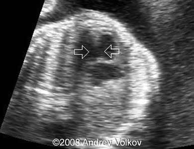 📃 Amniotic rupture