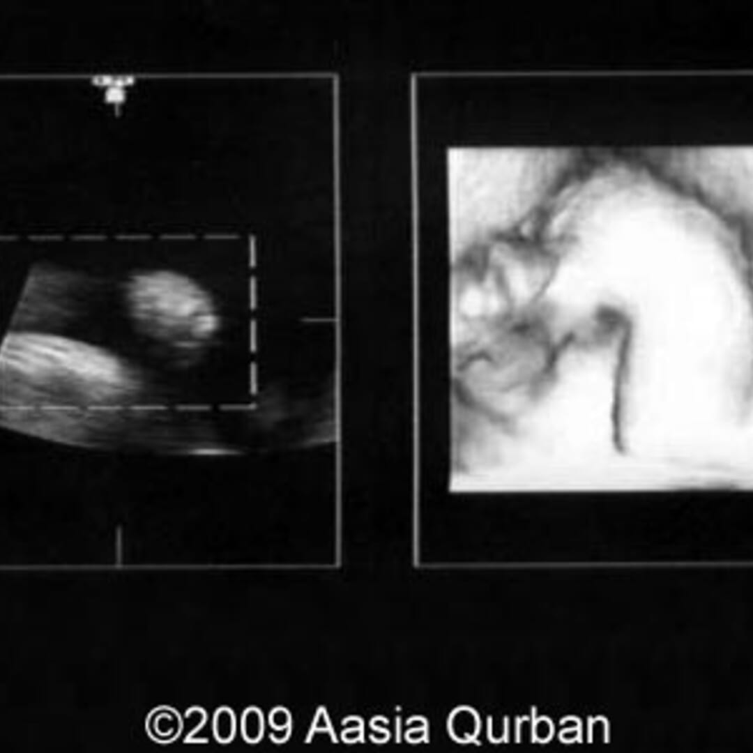 Neu Laxova Syndrome