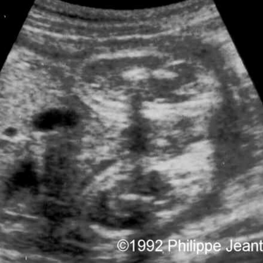 📃 Exstrophy of the cloaca sequence
