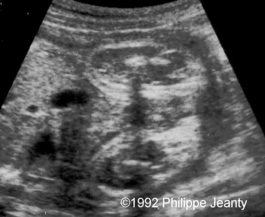 📃 Exstrophy of the cloaca sequence