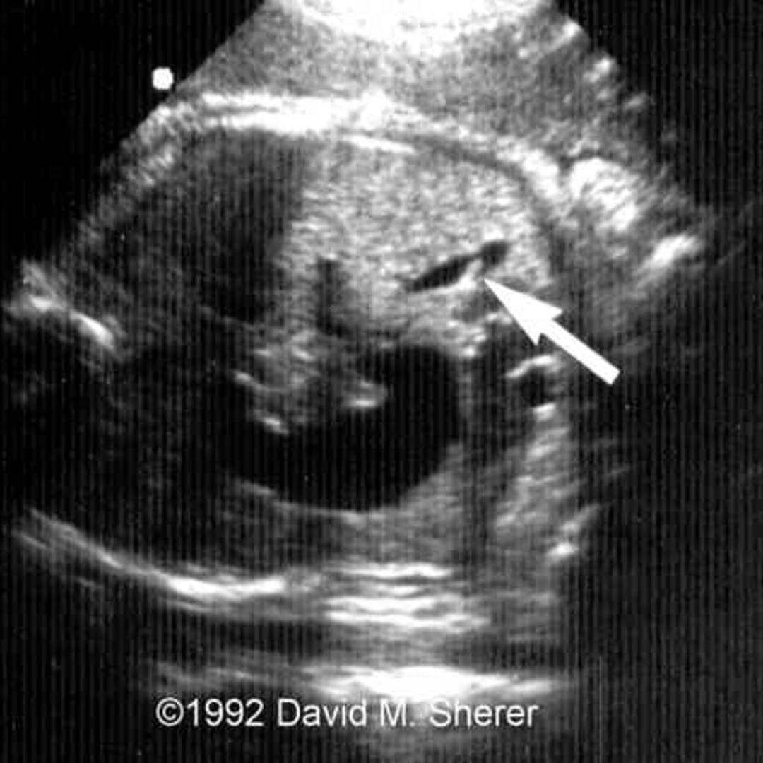 📃 Gallbladder, septation